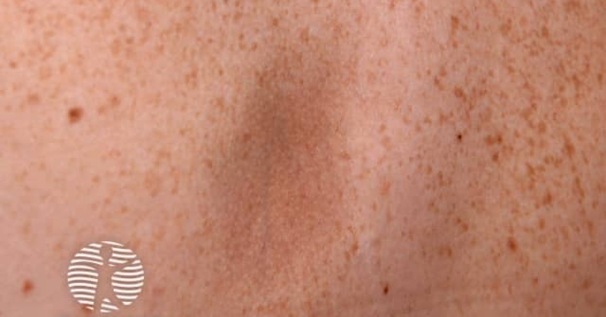 Atrophoderma of Pierini and Pasini image