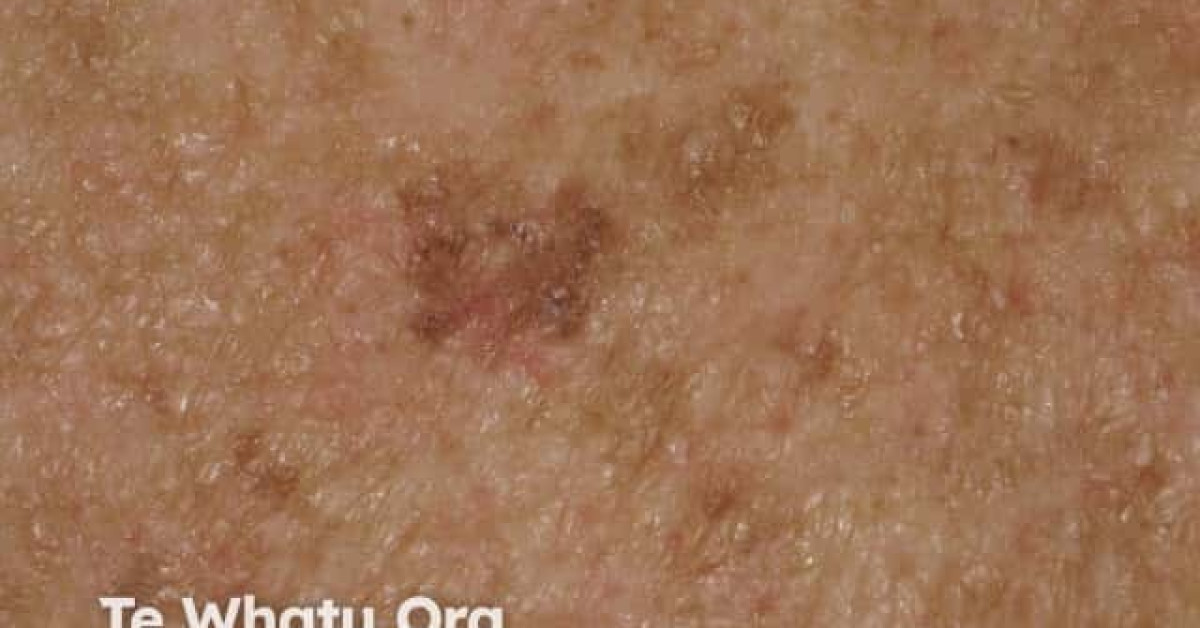 Atypical solar lentigo image