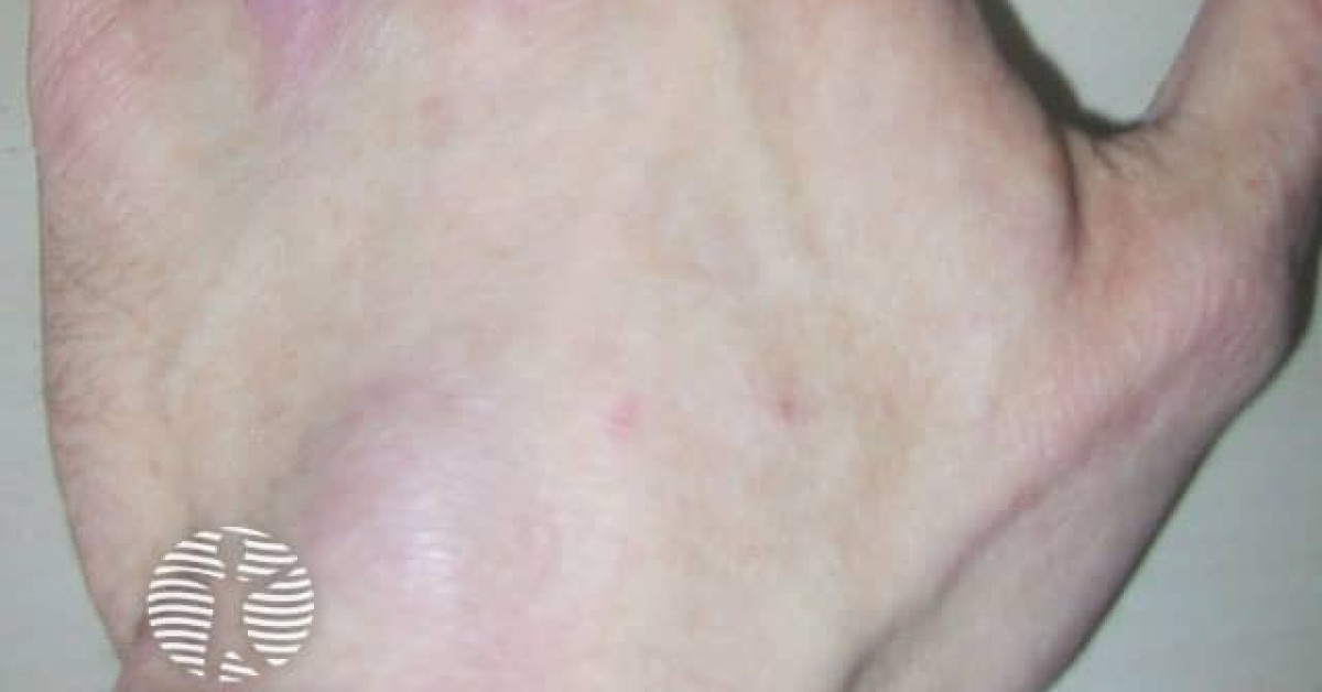 Mycobacterium marinum image