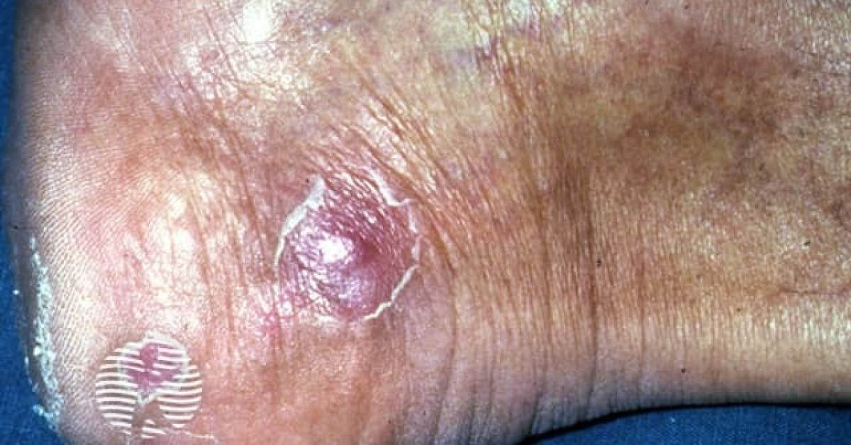 Cutaneous tuberculosis: Bazin disease image