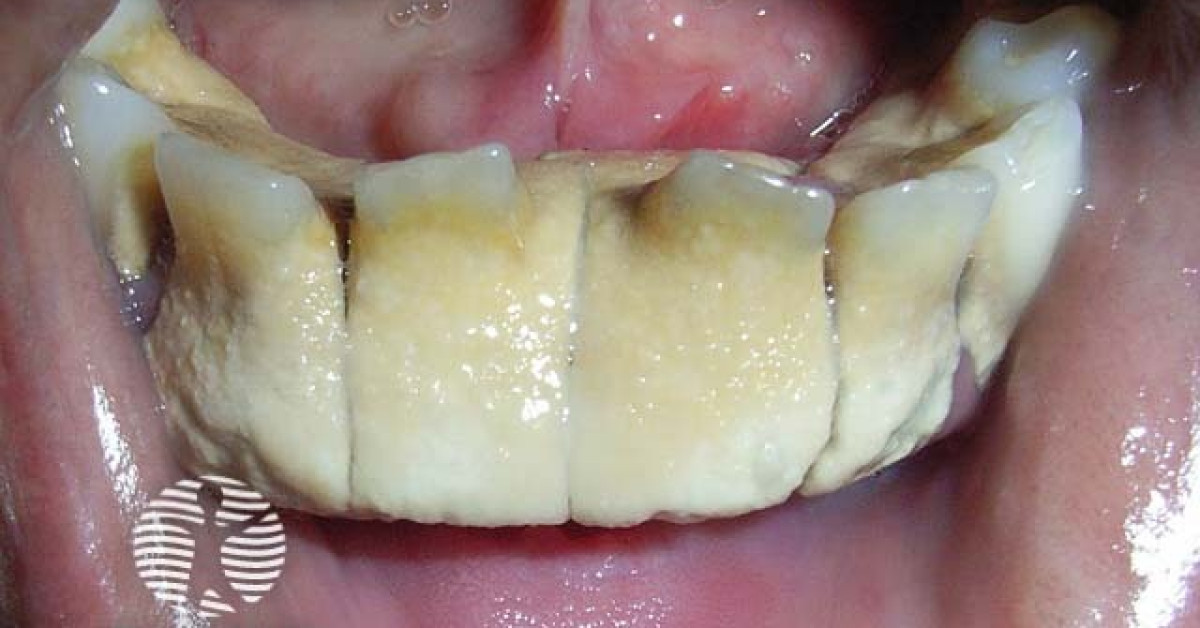Dental plaque image
