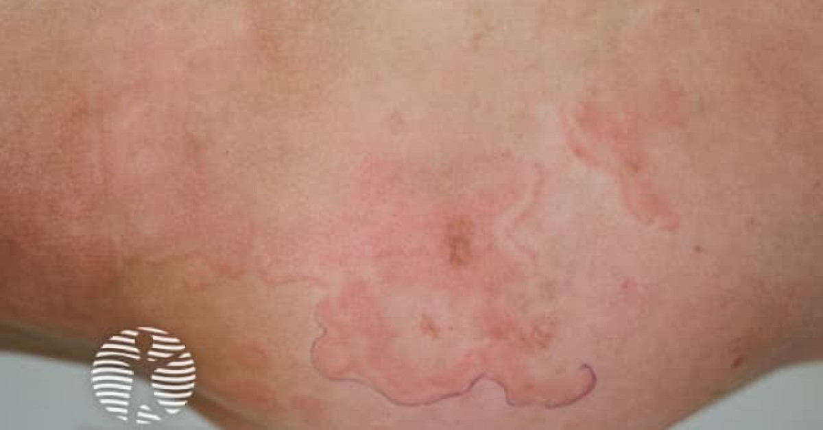 Erythema marginatum image
