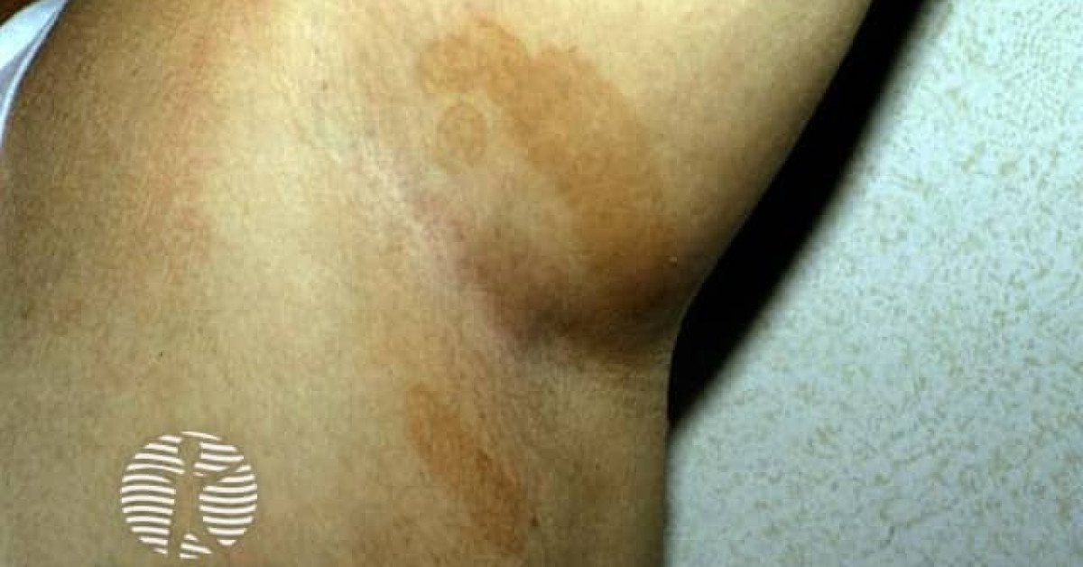 Axillary erythrasma image
