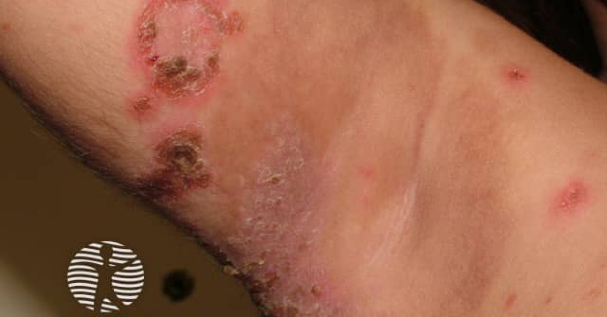 Impetigo image