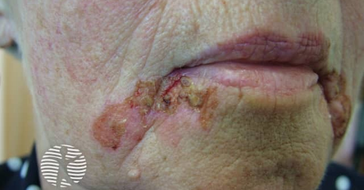 Impetigo image