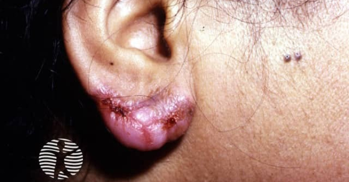 Cutaneous tuberculosis: lupus vulgaris image