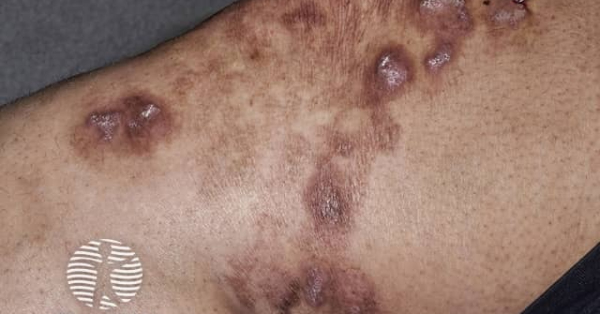 Mycobacterium marinum image