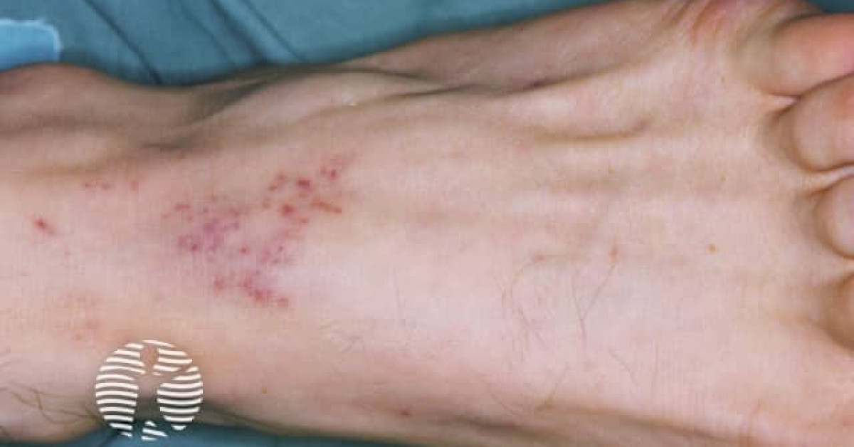 Meningococcal petechiae image