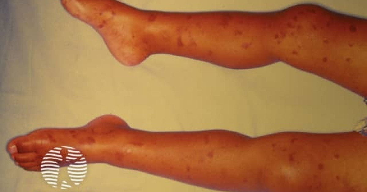 Meningococcal petechiae image