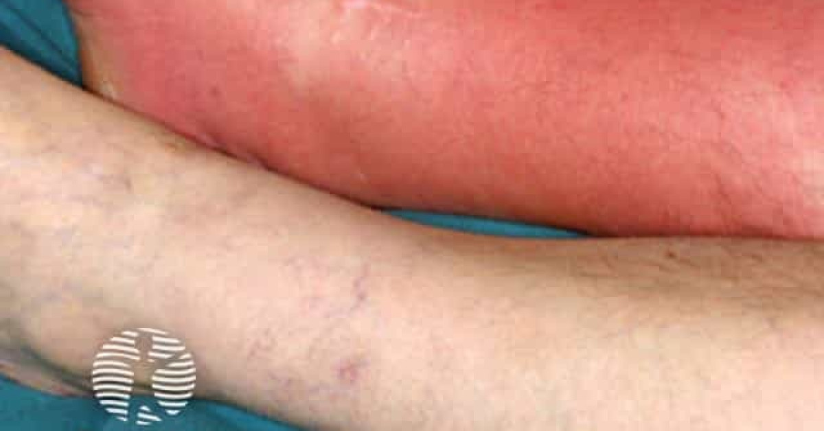 Cellulitis image