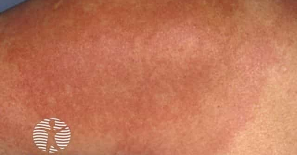 Psoriasis Migrans: Erythema Migrans Als Köbner-Phänomen Bei Psoriasis ...