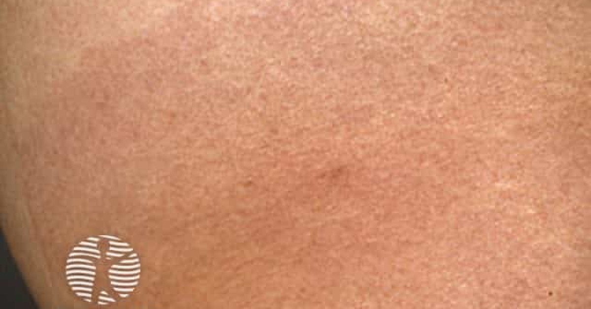 Erythema chronicum migrans image