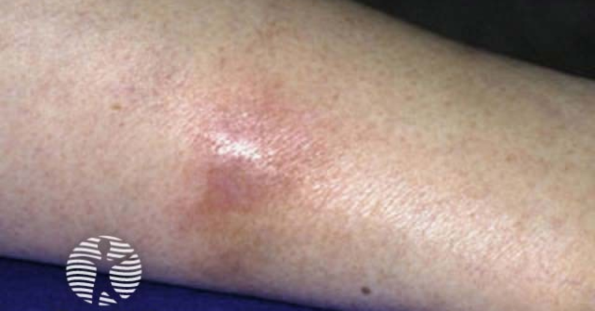 Erythema induratum image