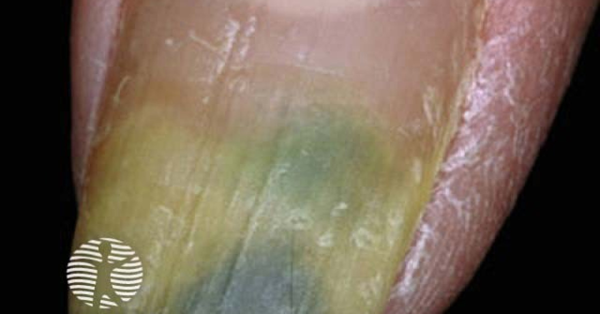 Pseudomonas infection image