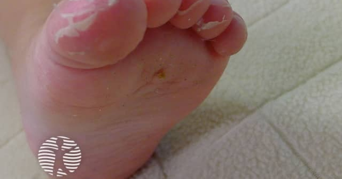 Peeling toes after scarlet fever image