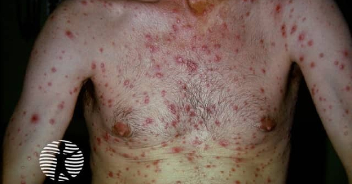 Syphilis image