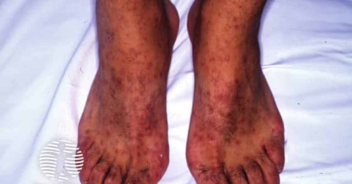Syphilis image
