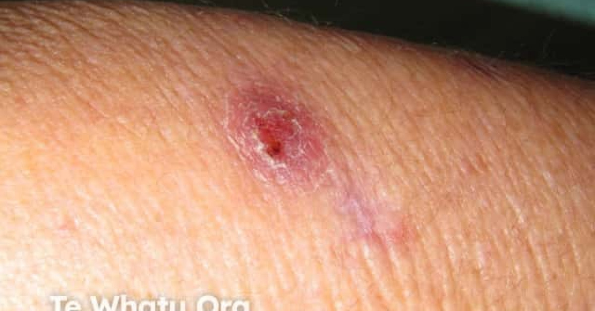 Mycobacterium abscessus image