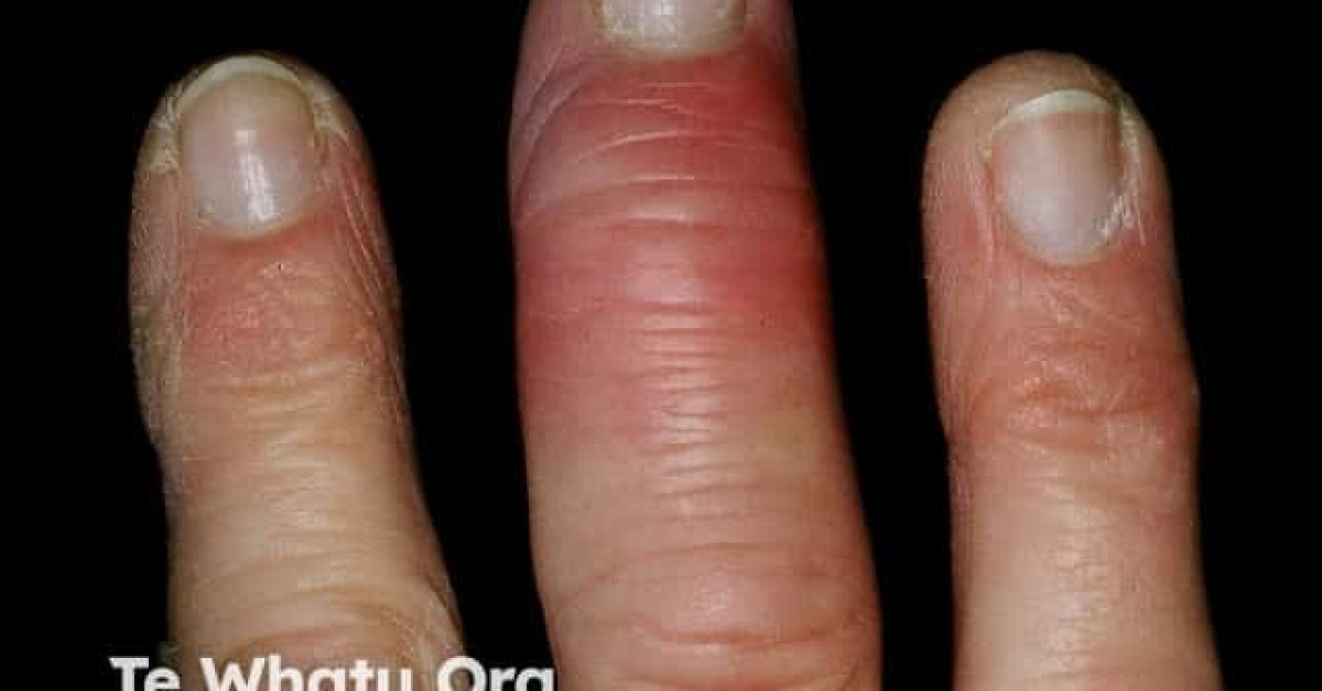 Erysipeloid image