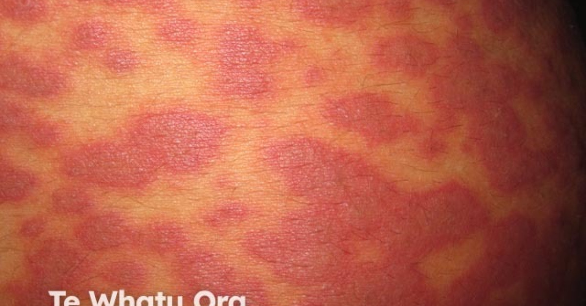 Atypical Erythema Multiforme Due To Mycoplasma Image