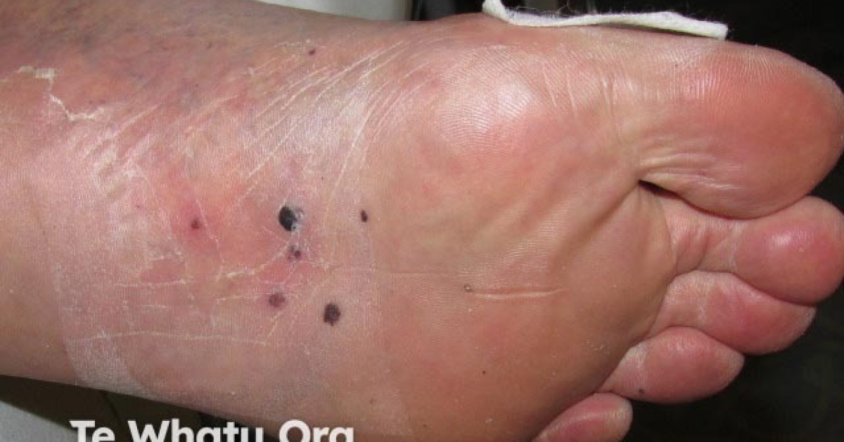 Septic Emboli Image
