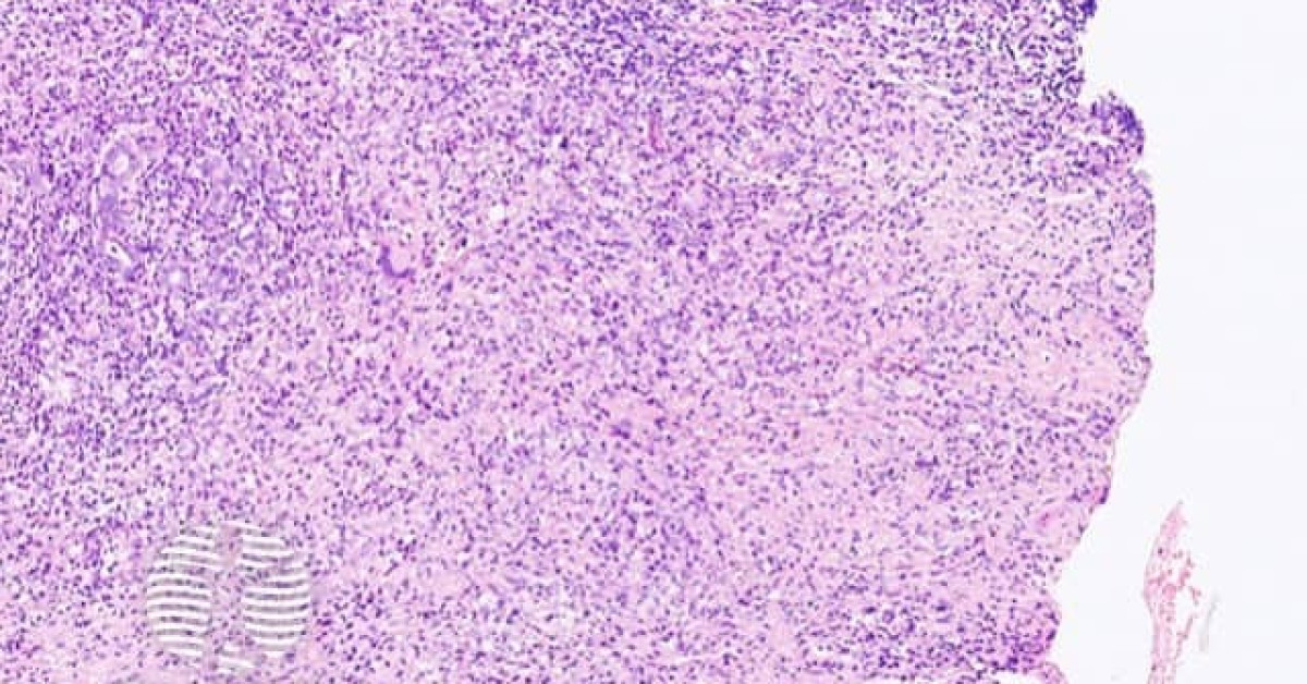 Balamuthia mandrillaris pathology image