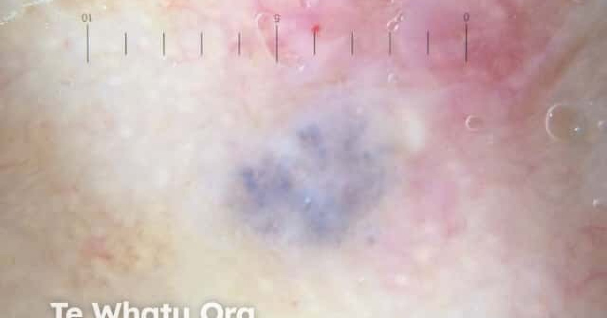 Basal cell carcinoma image