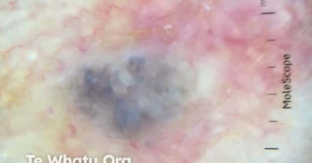 Basal cell carcinoma image