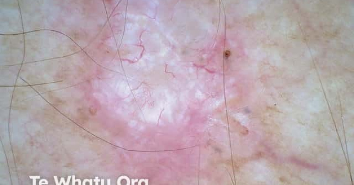 Nonpigmented nodular basal cell carcinoma dermoscopy image