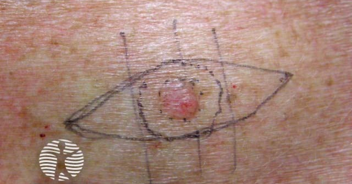 Excision margins image