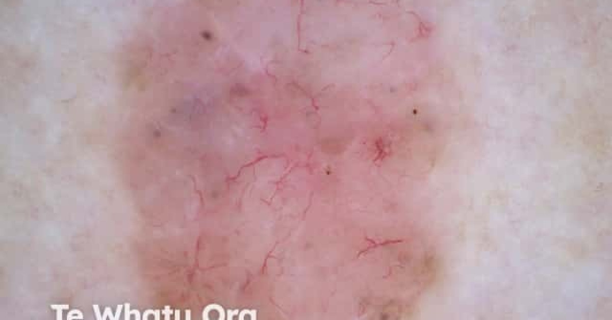 Nodular Basal Cell Carcinoma Dermoscopy Image