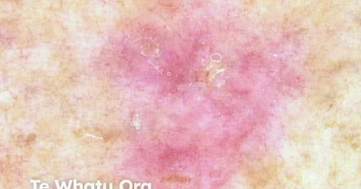 Superficial basal cell carcinoma 1 dermoscopy image