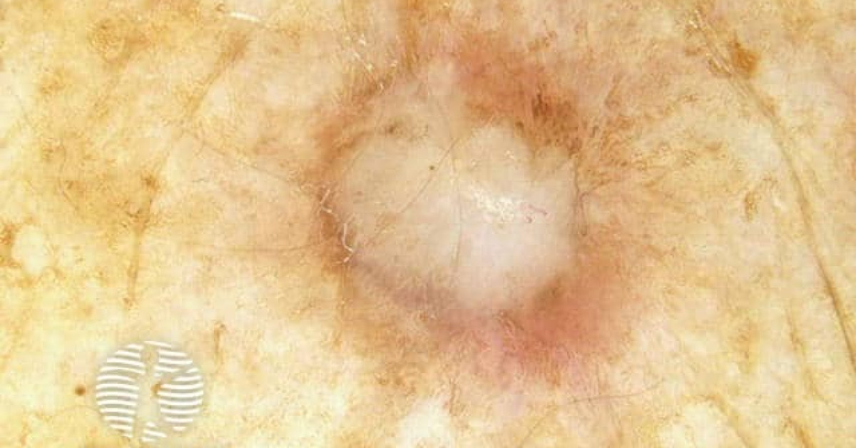 Basal cell carcinoma dermoscopy image