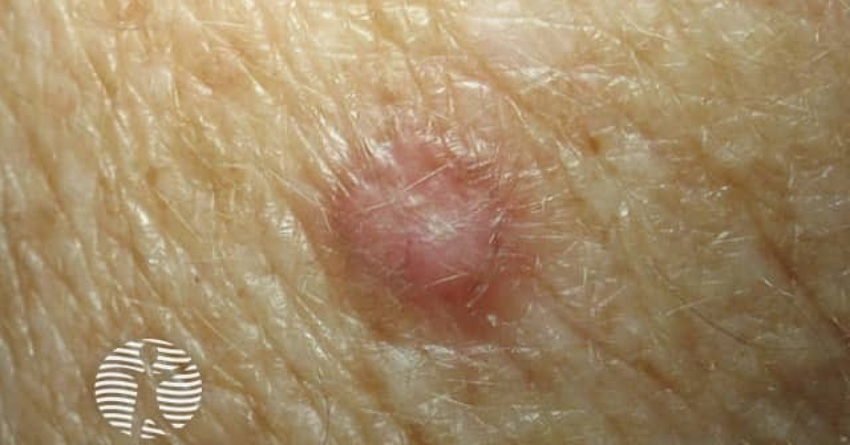 Basal cell carcinoma image