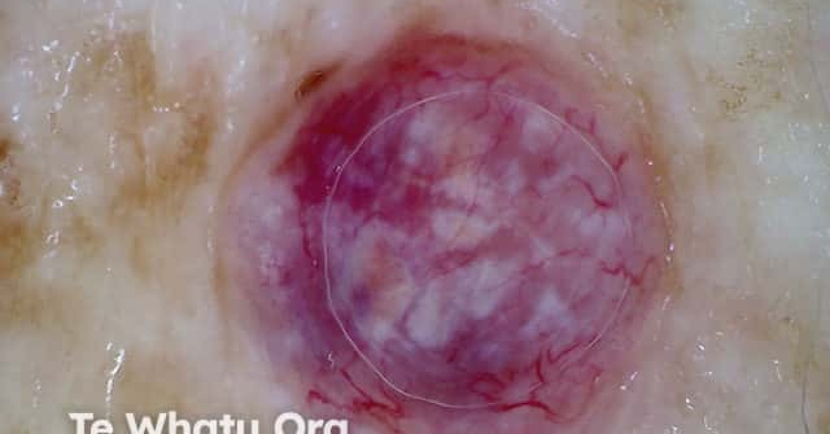 Left Lateral Upper Arm image