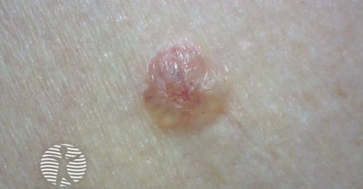 Nodular Basal Cell Carcinoma Image