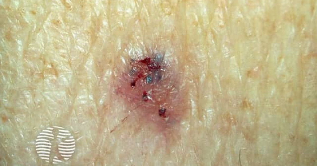 Basal cell carcinoma, arm image