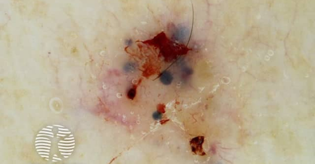 Blue-grey ovoid nests in pigmented basal cell carcinoma dermoscopy image