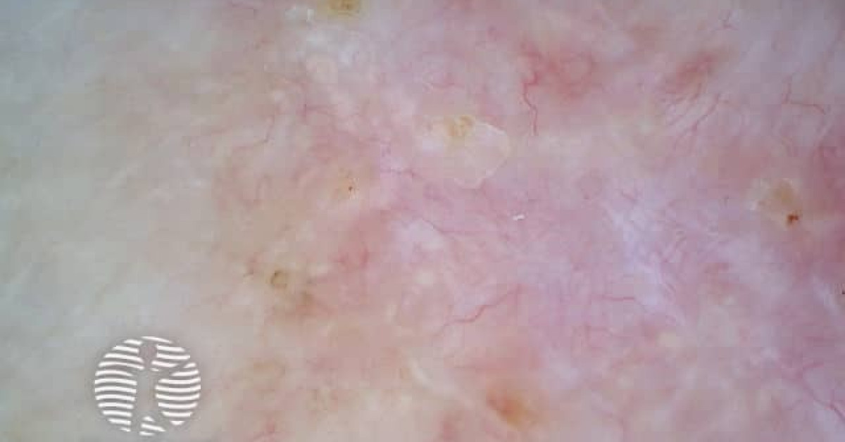 Basal cell carcinoma dermoscopy image