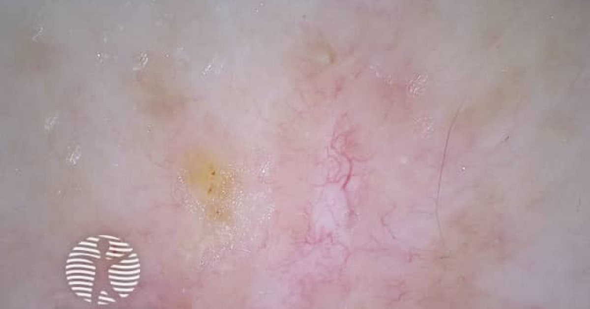 Basal cell carcinoma dermoscopy image