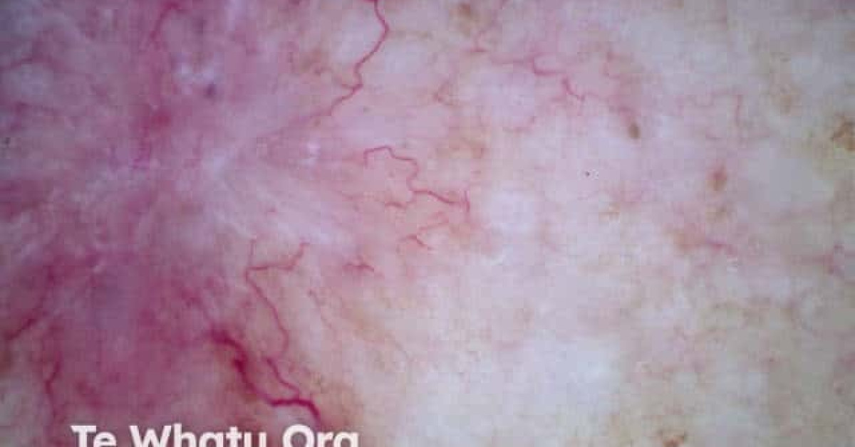 Basal Cell Carcinoma Dermoscopy Image
