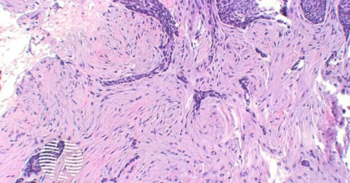DermNet® - Basal cell carcinoma pathology image