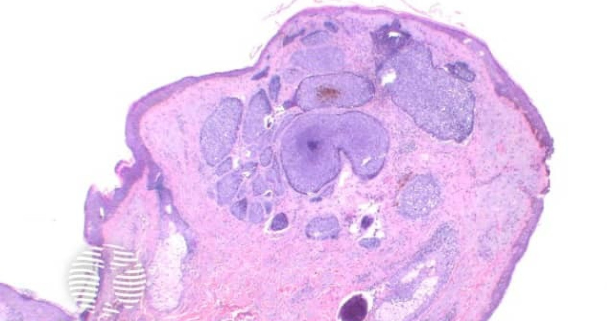 Basal Cell Carcinoma Pathology Image