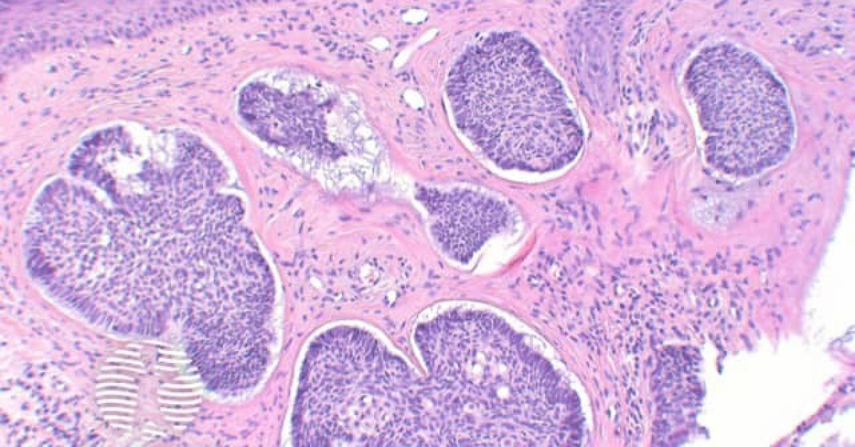 Basal Cell Carcinoma Pathology Image