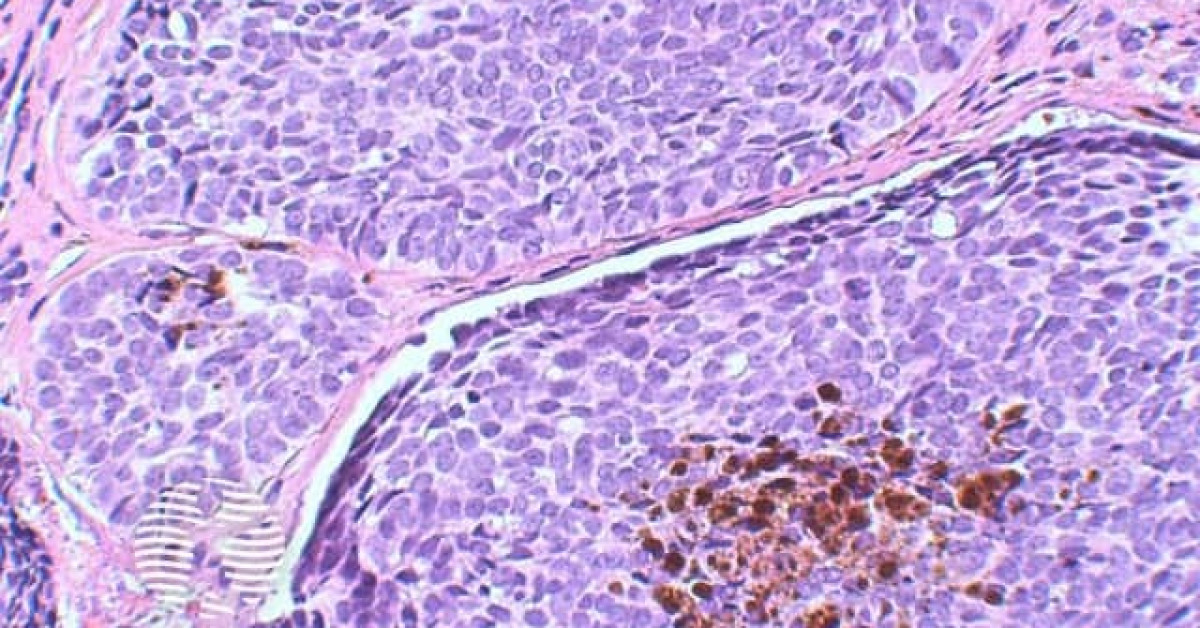 Basal cell carcinoma pathology image