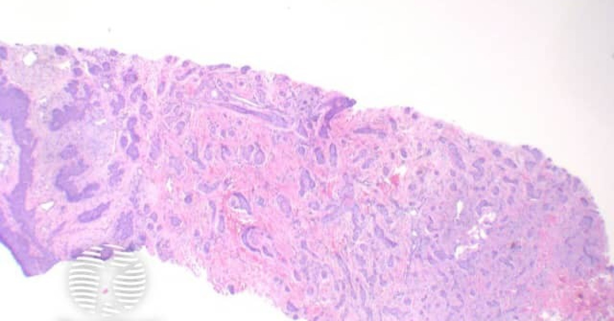 Basal cell carcinoma pathology image