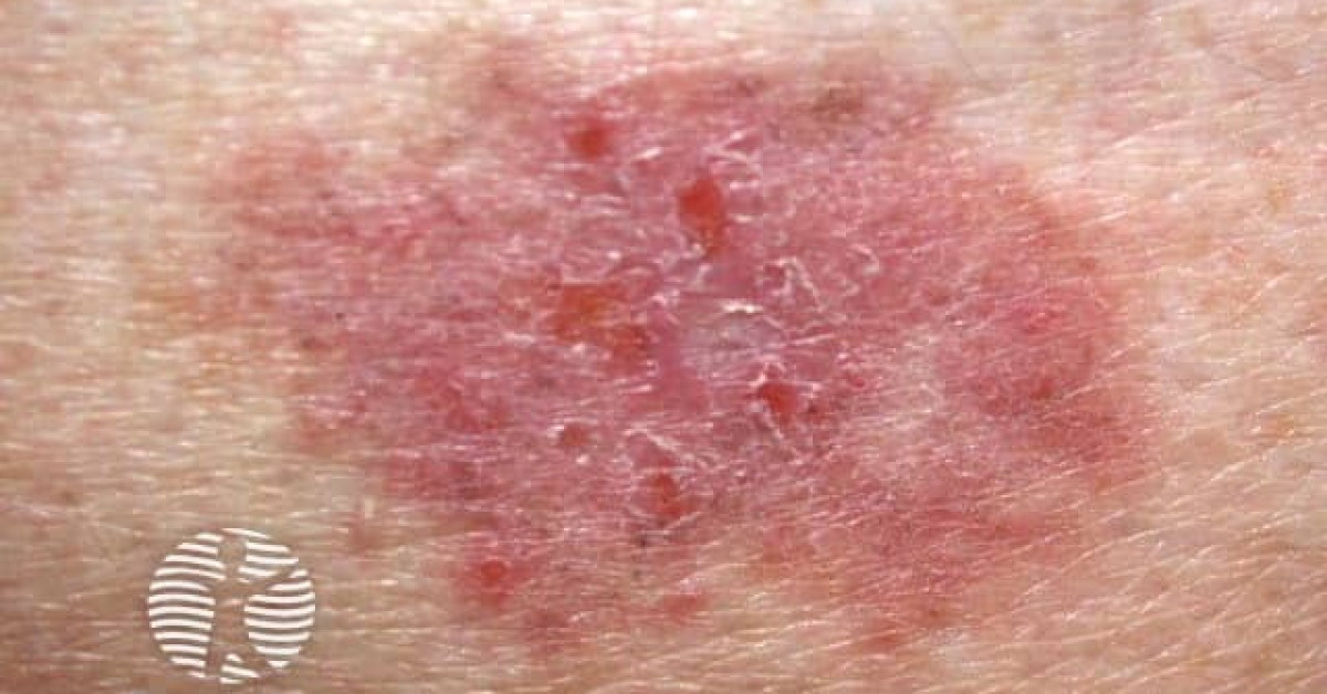 Basal cell carcinoma, leg image