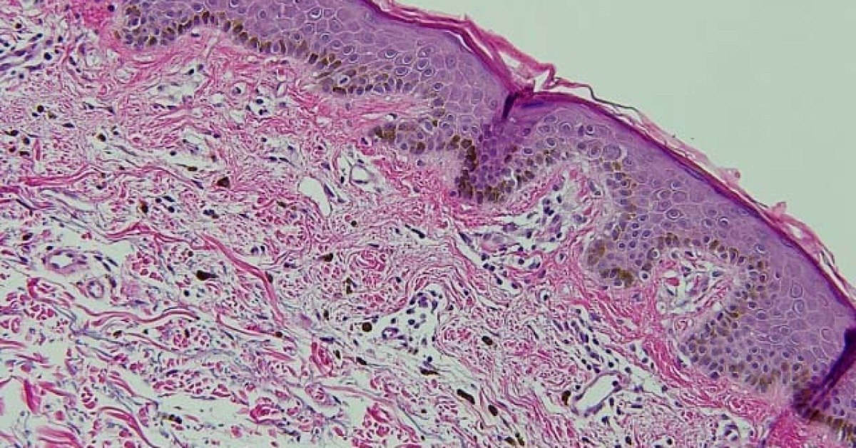 Histology of solar lentigo image