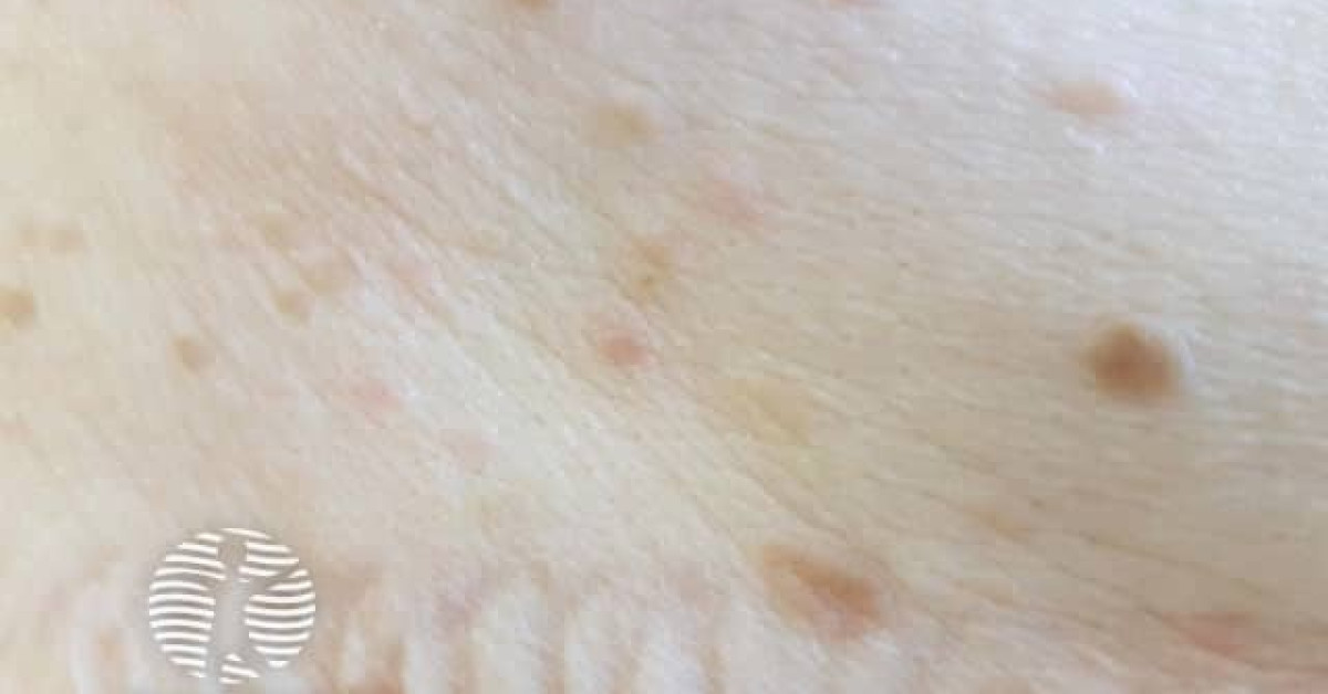 Poultry mite bites image