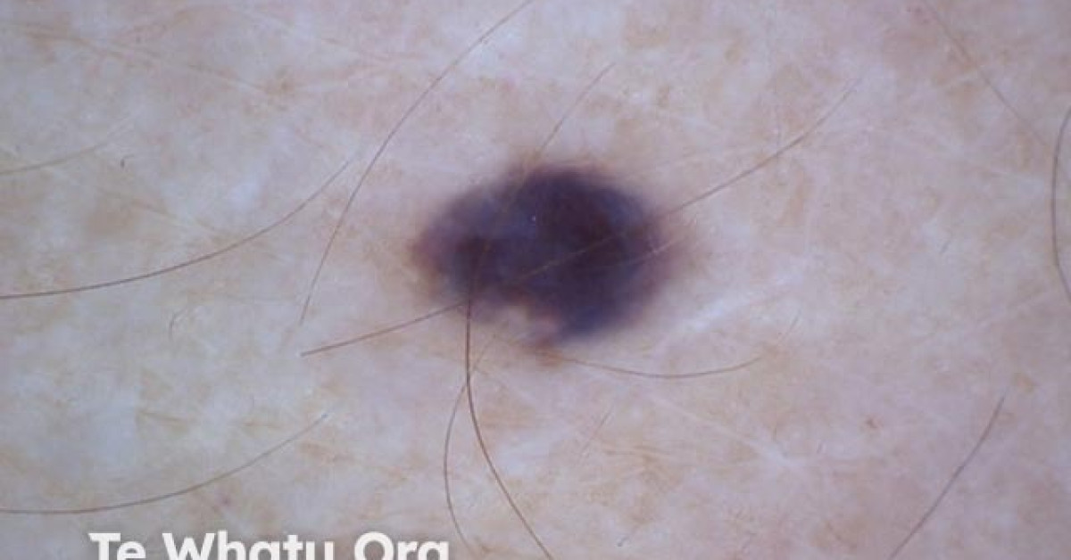 Blue naevus, skin type 2, dermoscopy image